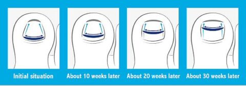 Onyfix Nail Correction System | My Foot Clinic